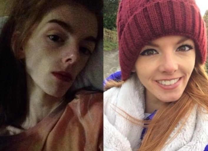 Voici ce qui a aidé à récupérer cette fille qui souffrait d'anorexie et ...